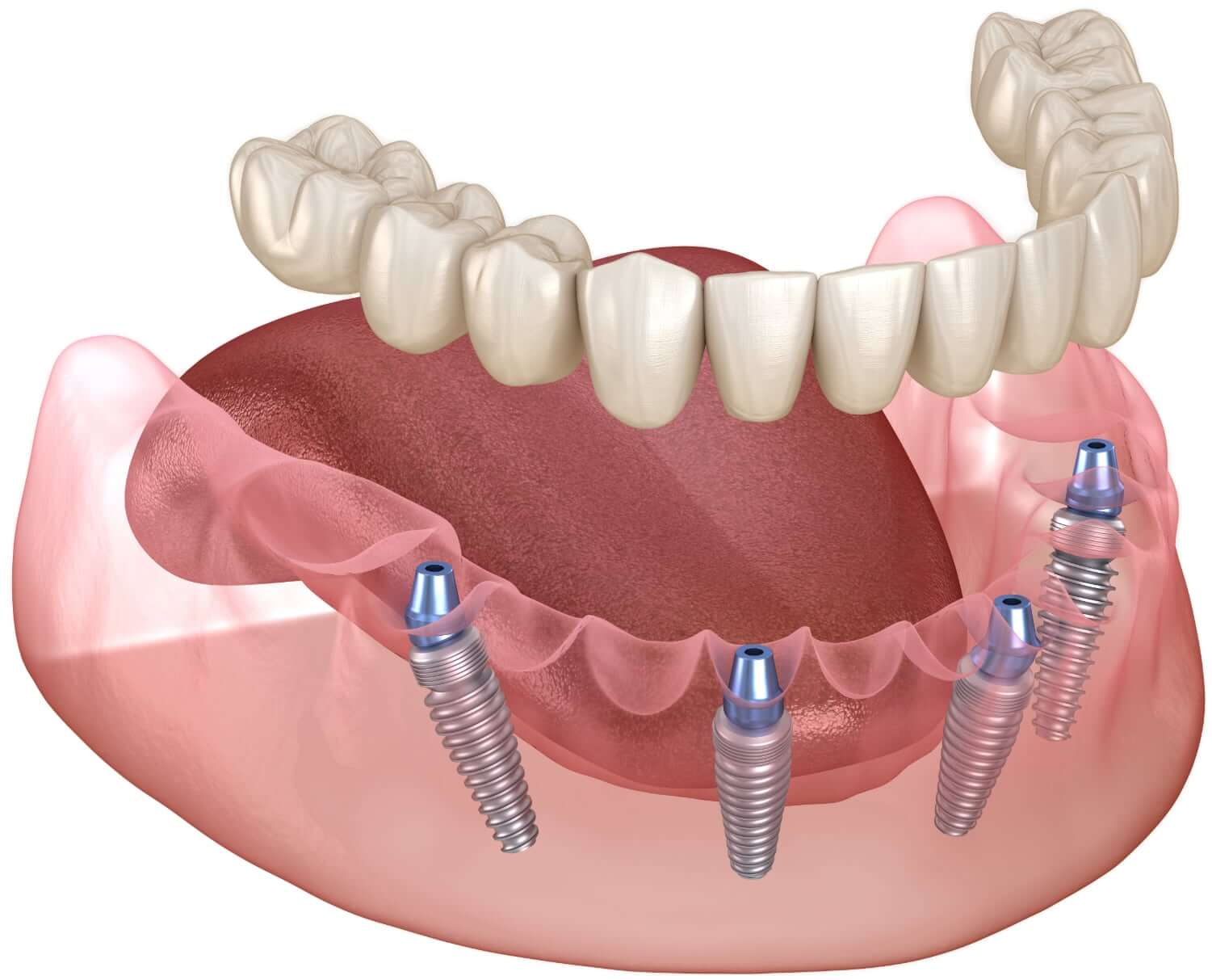 New Teeth In One Day | Grillo Dental Windsor